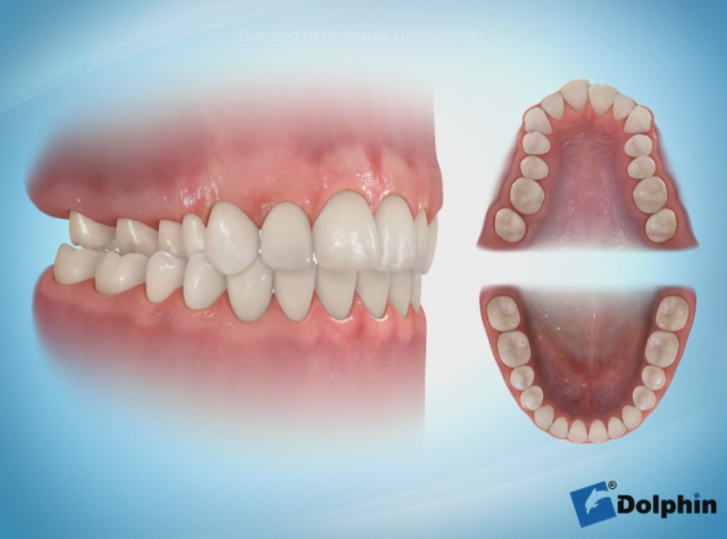 Bite into it – Orthodontics: more than just straight teeth - Peninsula ...